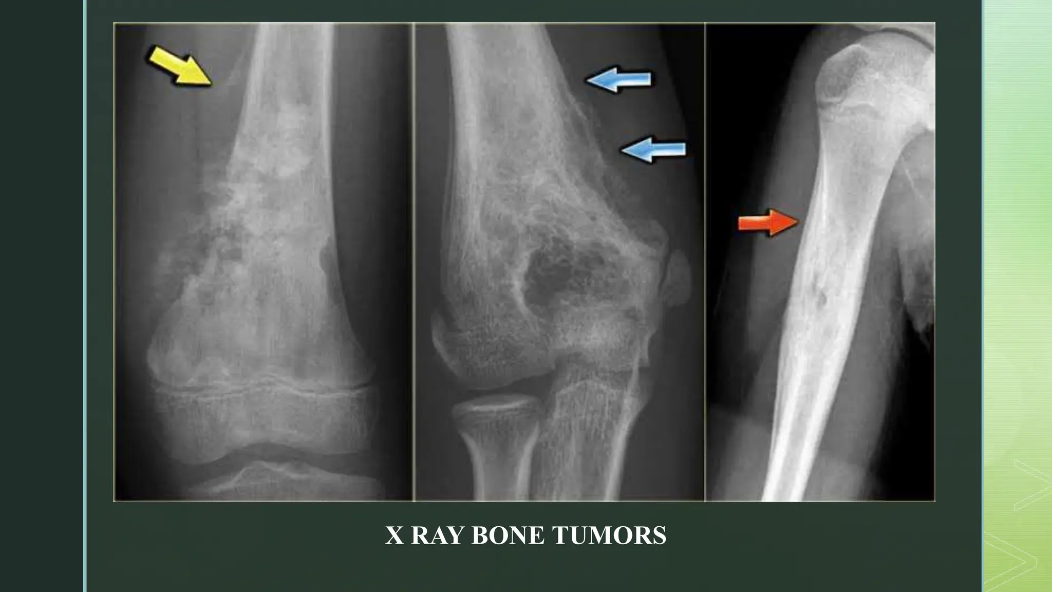 Bone tumors.pptx