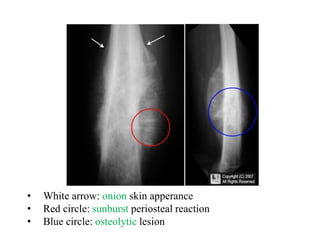 Bone tumor a lecture for orthopedicS.pdf