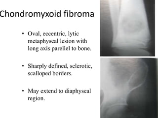 Radiological and pathological correlation of bone tumours Dr.Argha ...