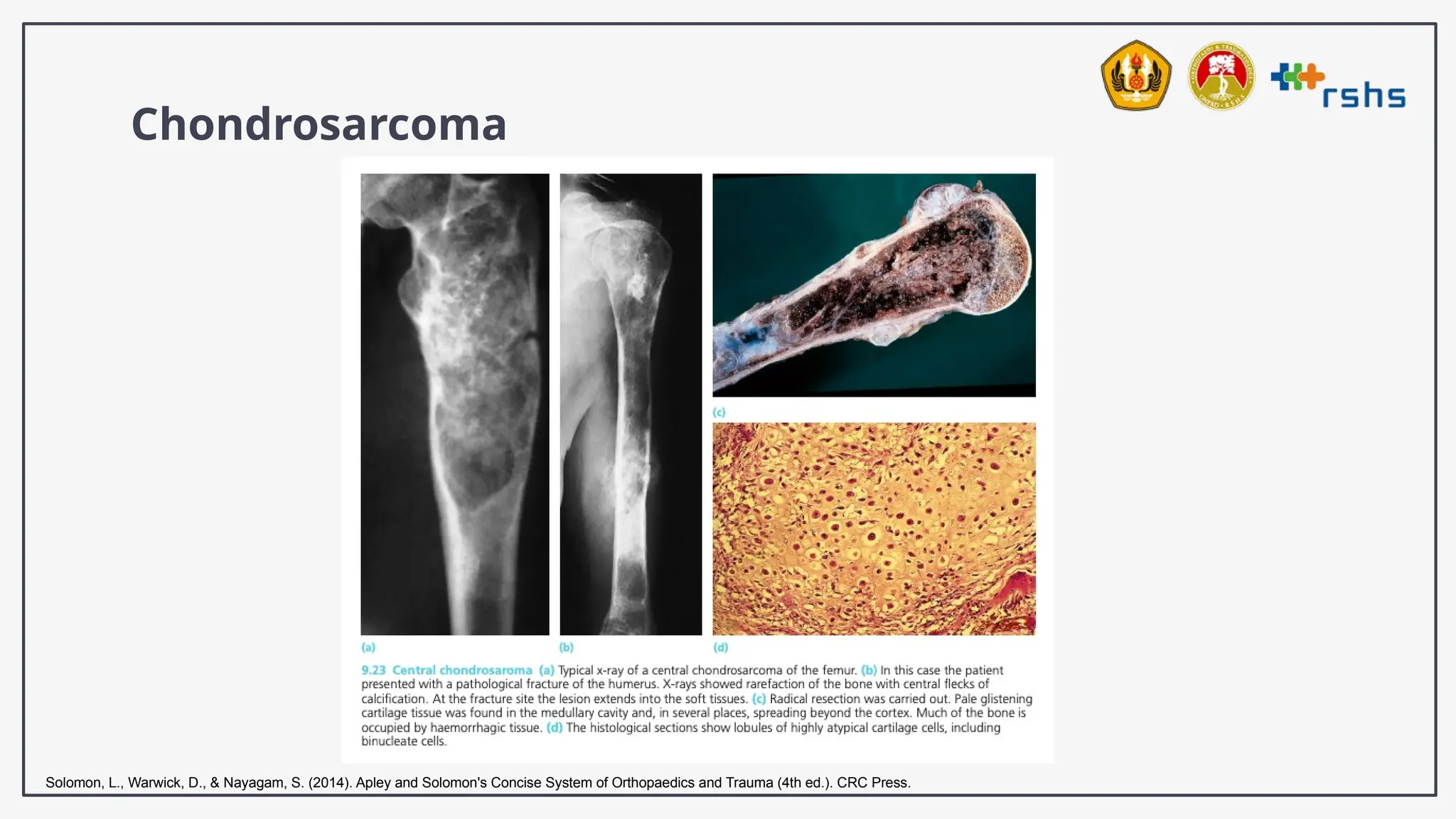 tumor eganasan dan jinak pada tulang.pptx | Physical Therapy | Wellness