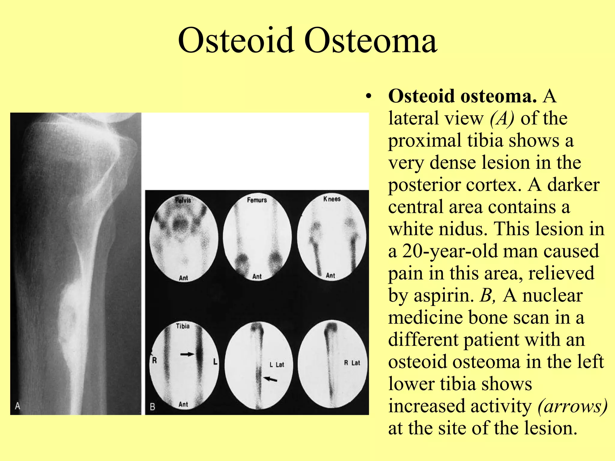Bone tumors and tumor-like lesions.ppt