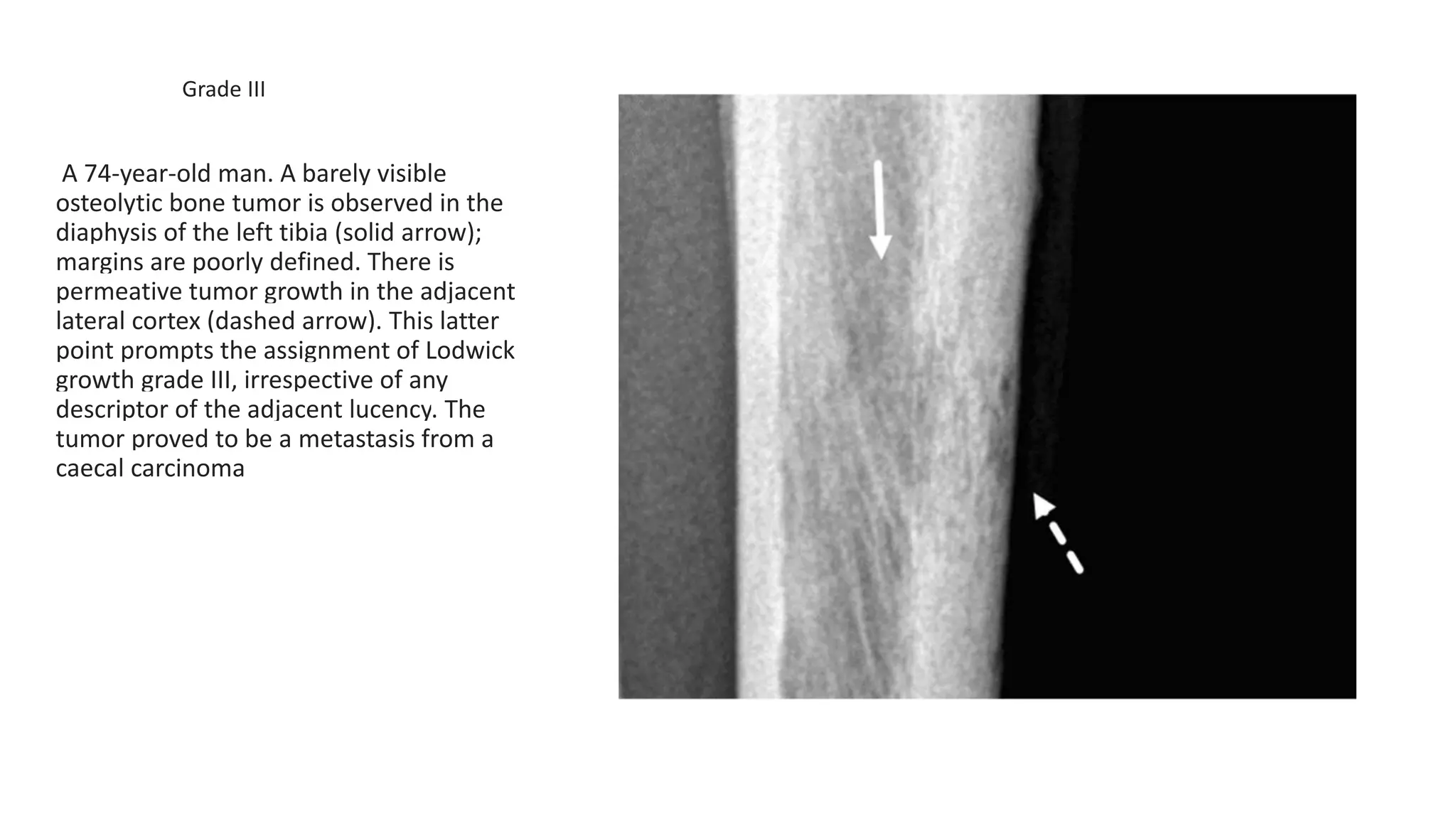 bone tumors final presentation in different sce | PPTX