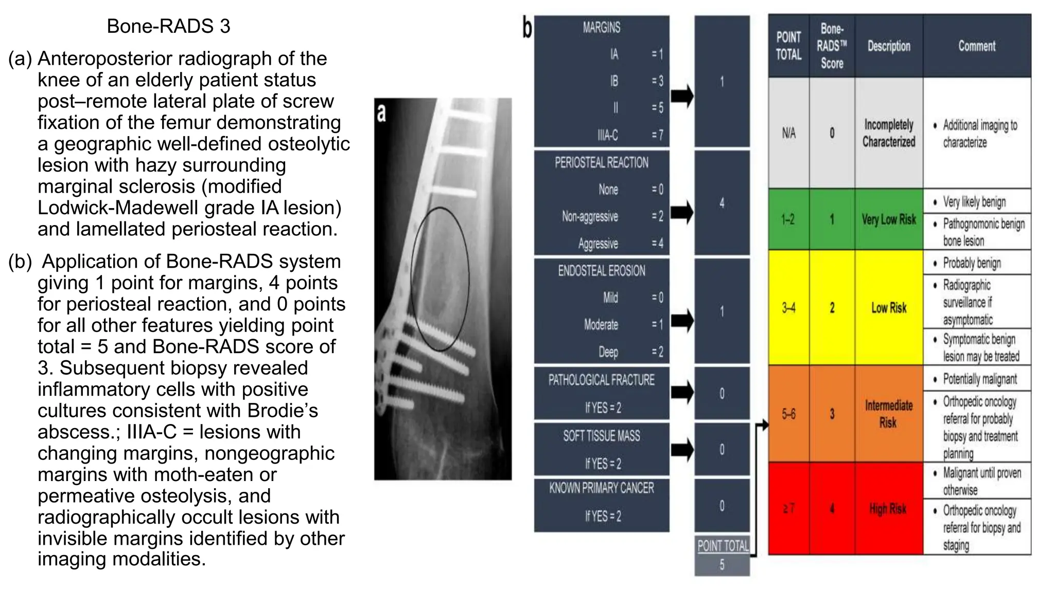 bone tumors final presentation in different sce | PPTX