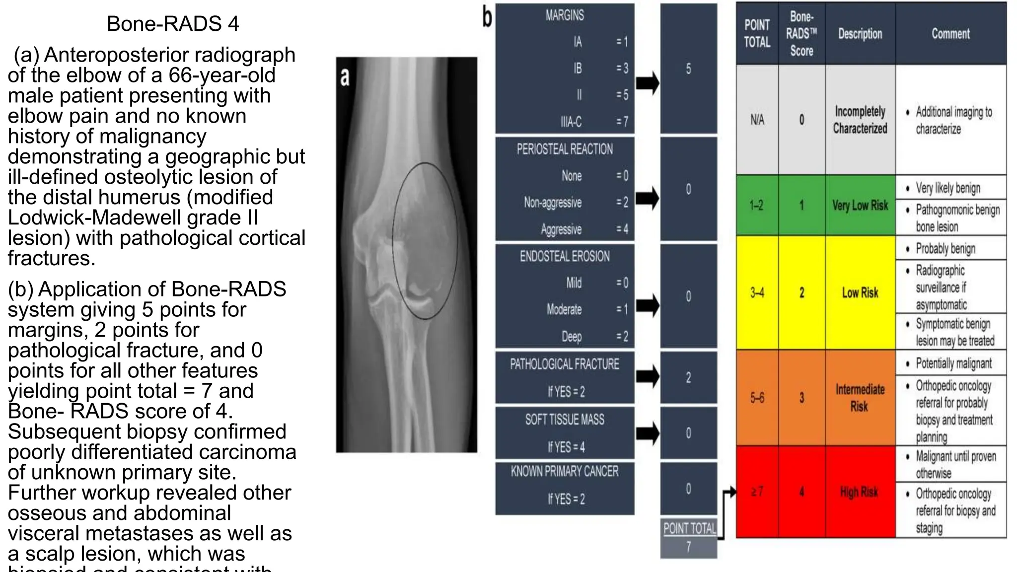 bone tumors final presentation in different sce | PPTX