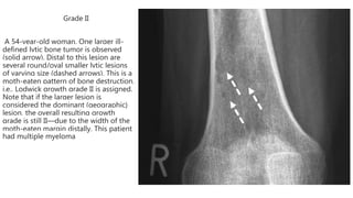 bone tumors final presentation in different sce | PPTX