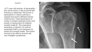 bone tumors final presentation in different sce | PPTX