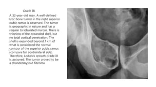 bone tumors final presentation in different sce | PPTX