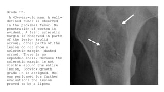 bone tumors final presentation in different sce | PPTX