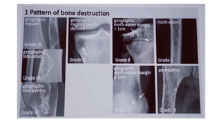 bone tumors final presentation in different sce | PPTX