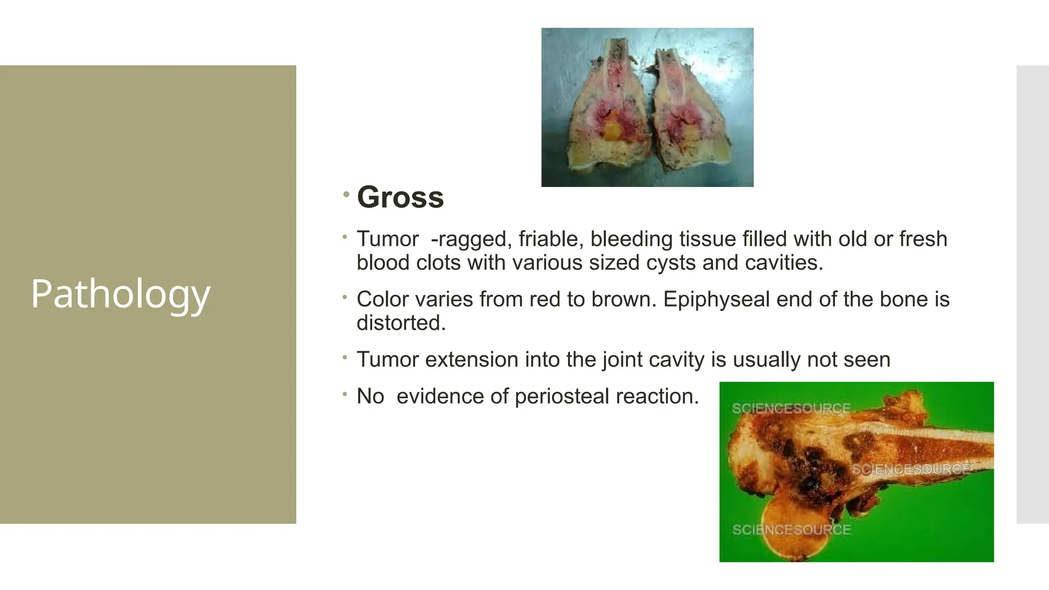 BONE TUMORS introductions classifications | PPTX