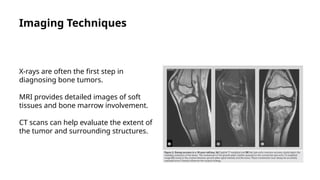 Bone Tumors new.pptx. . | PPTX