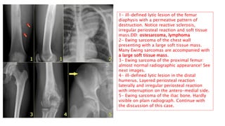 Bone tumors part 2 | PPT