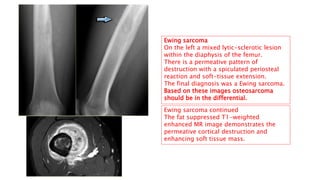 Bone tumors part 2 | PPT
