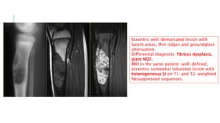 Bone tumors part 2 | PPT