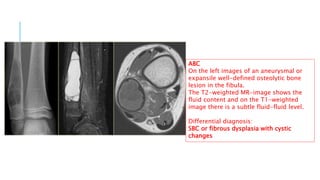 Bone tumors part 2 | PPT