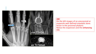 Bone tumors part 2 | PPT