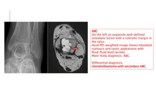 Bone tumors part 2 | PPT