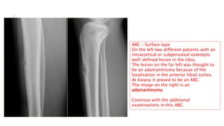 Bone tumors part 2 | PPT