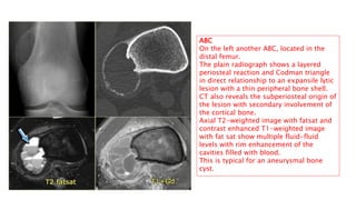 Bone tumors part 2 | PPT