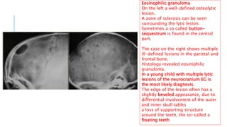 Bone tumors part 2 | PPT