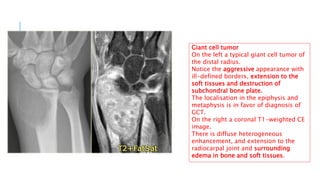 Bone tumors part 2 | PPT