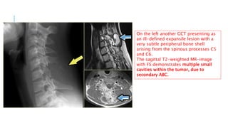 Bone tumors part 2 | PPT