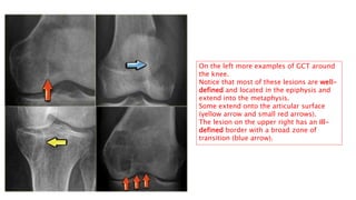 Bone tumors part 2 | PPT