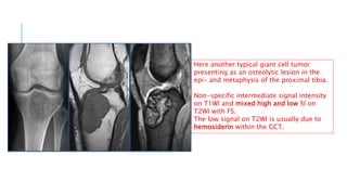 Bone tumors part 2 | PPT