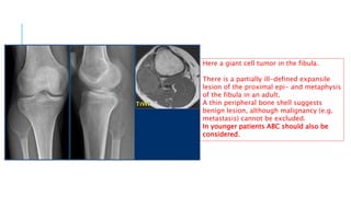 Bone tumors part 2 | PPT