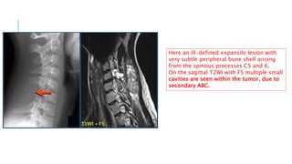 Bone tumors part 2 | PPT