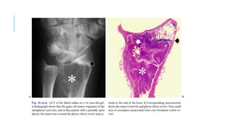 Bone tumors part 2 | PPT