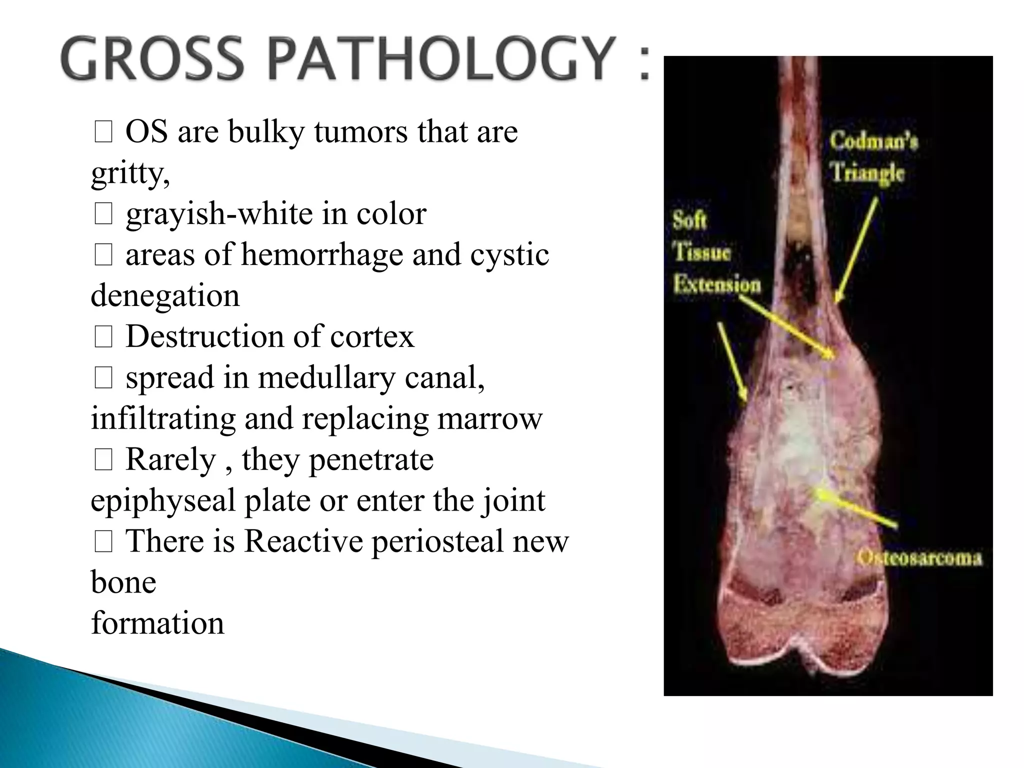 Bone tumors :CLASSIFICATION ,EWING'S & OSTEOSARCOMA | PPTX