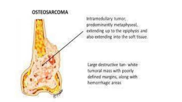 BONE TUMORS PPT malignant and benign for study | PPTX