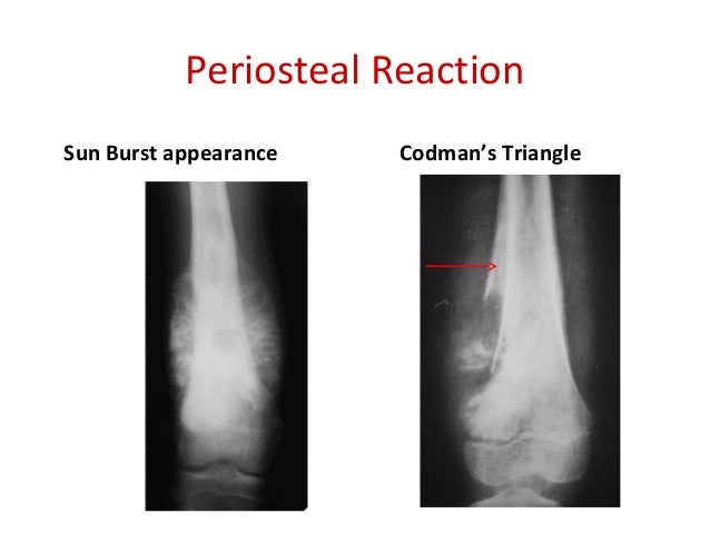 Bone tumors pre management