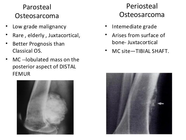Bone Tumors In Children Sarcoma Tumor Ewing39s Sarcoma