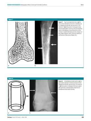 bone tumors x ray.pdfThis comprehensive review by Dr. Theodore T ...