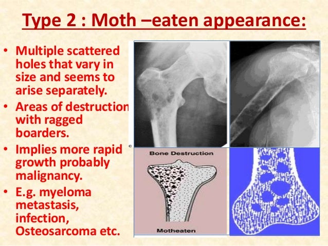 Bone tumour