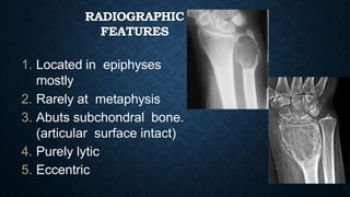Bone tumour gct | PPT