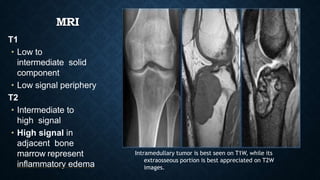 Bone tumour gct | PPT