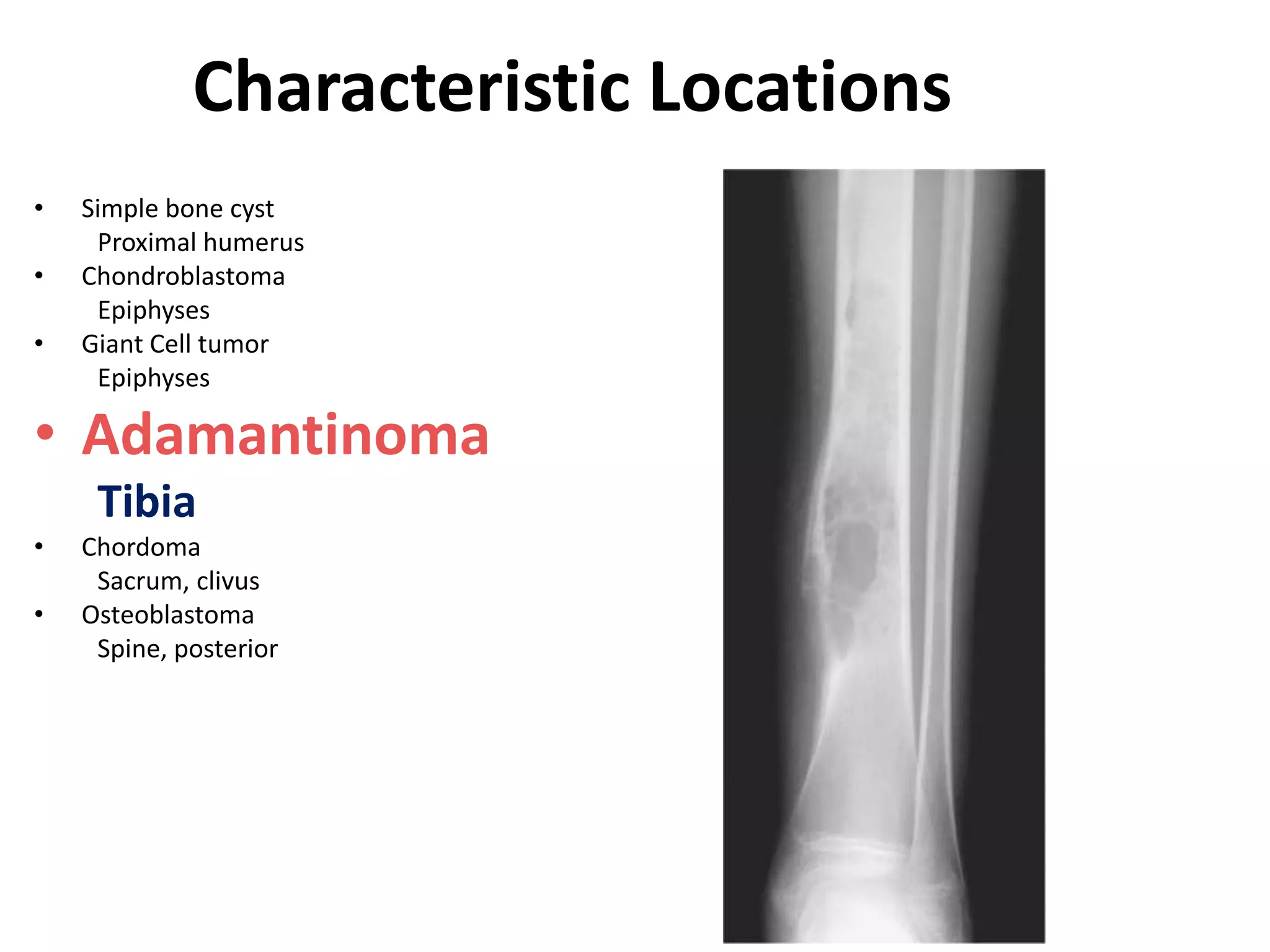 Bone tumour , enchondroma , osteochondroma | PPTX