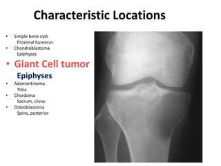 Bone tumour , enchondroma , osteochondroma | PPTX