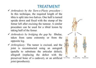Bone tumours (compiled by Dr. Sanjib Kumar Das) | PDF
