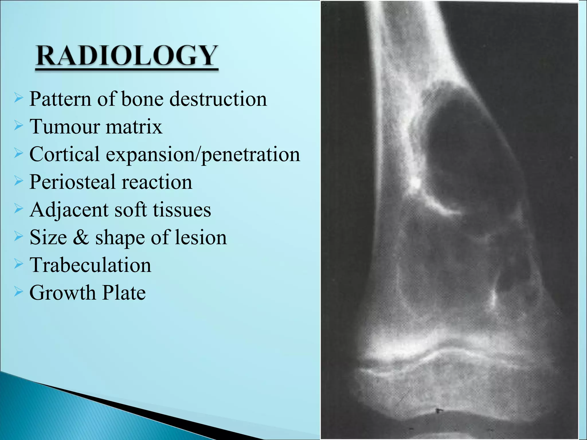 Bone tumours | PPT