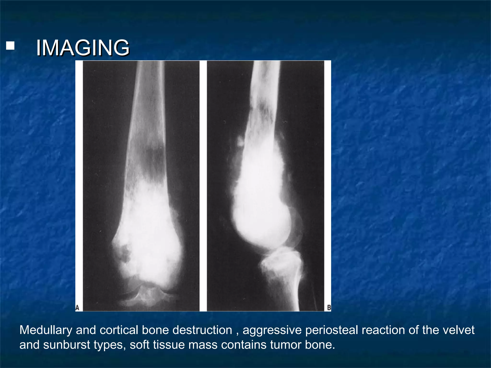 Bone tumours and principles of limb salvage surgery | PPT