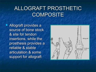Bone tumours and principles of limb salvage surgery | PPT