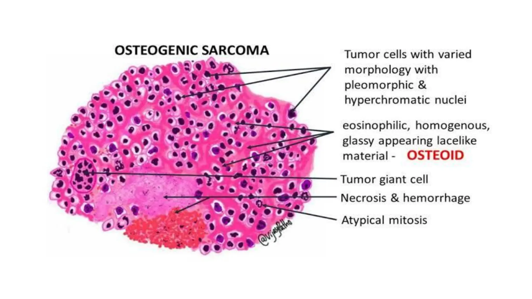 bone tumours BDS and different type of tumor 🤍 | PDF