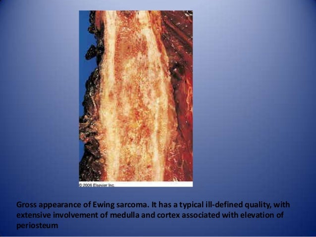 Bone tumour seminar ,ewing sarcoma, chordoma,