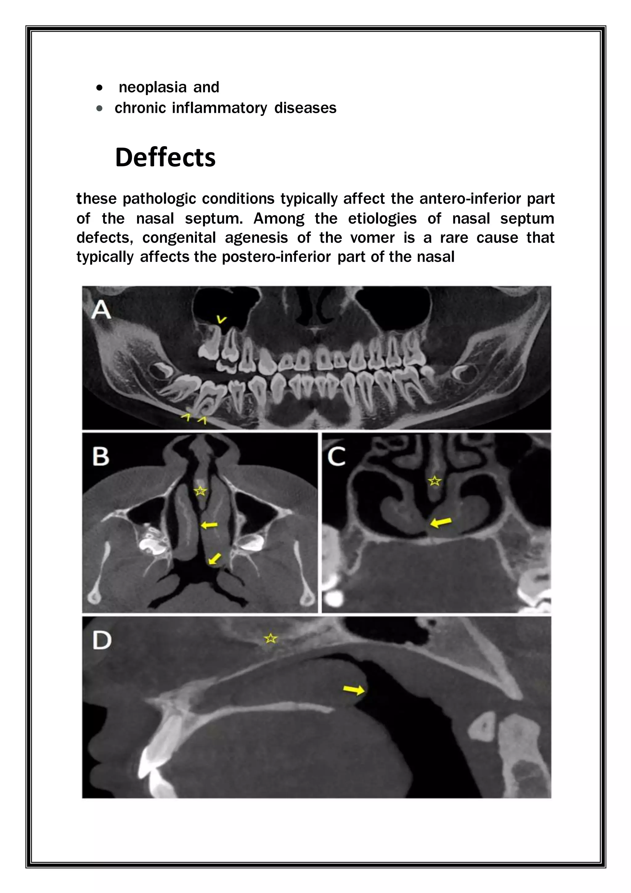 ANATOMY OF VOMER BONE | DOCX