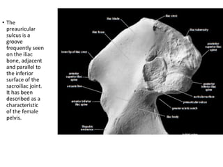 Preauricular Sulcus