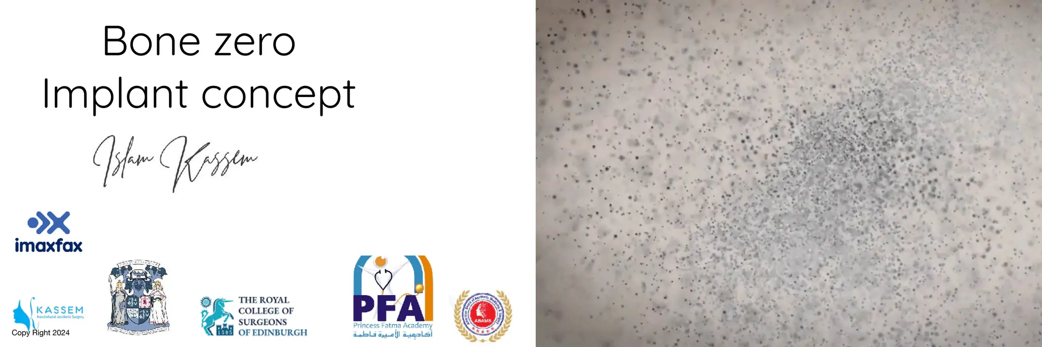 Bone zero dental implant for risky cases of severe bone resorption | PDF